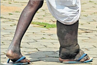 Ramchhung - Sorkarin Elephantiasis umbona tur campaign ṭan; A hluarna ...